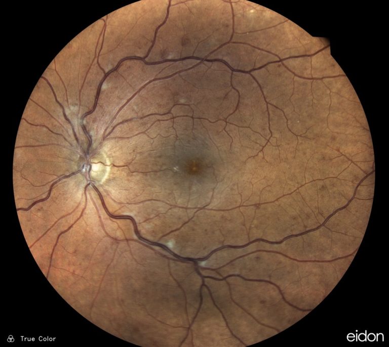 Occlusion veineuse rétinienne - Ophtalmo Laval